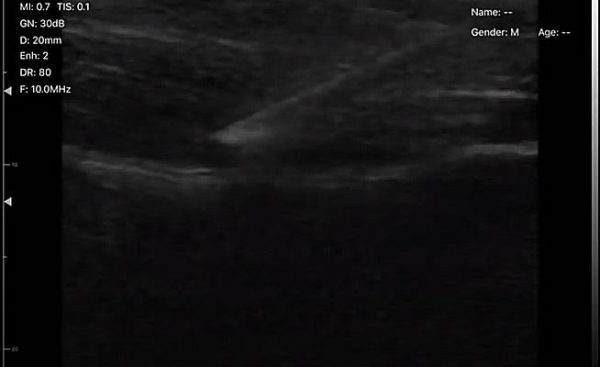 CDML-USonos: Mini-Linear Ultrasound Scanner - Uforya Medical